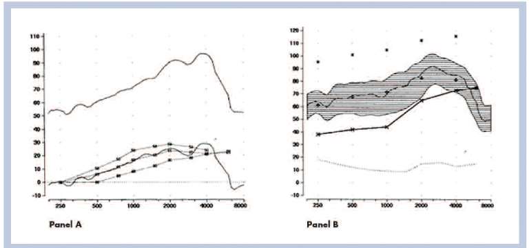 Considerations in Real-Ear Measurement: Points to Ponder | Canadian ...
