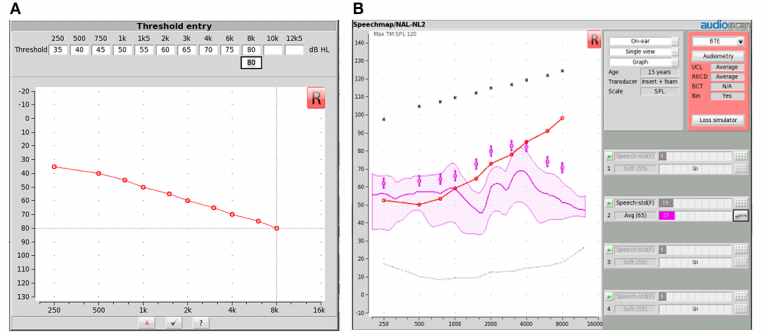 Considerations in Real-Ear Measurement: Points to Ponder | Canadian ...