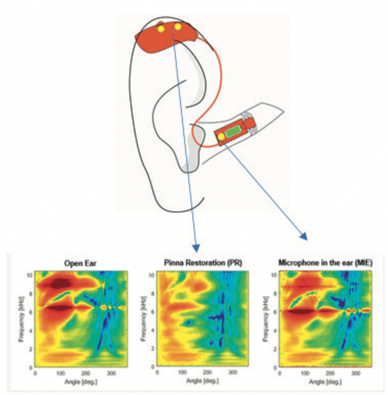 An innovative RIE with microphone in the ear lets users “hear with ...