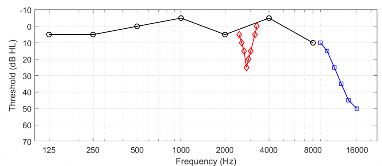 Tinnitus with a Normal Audiogram | Canadian Audiologist
